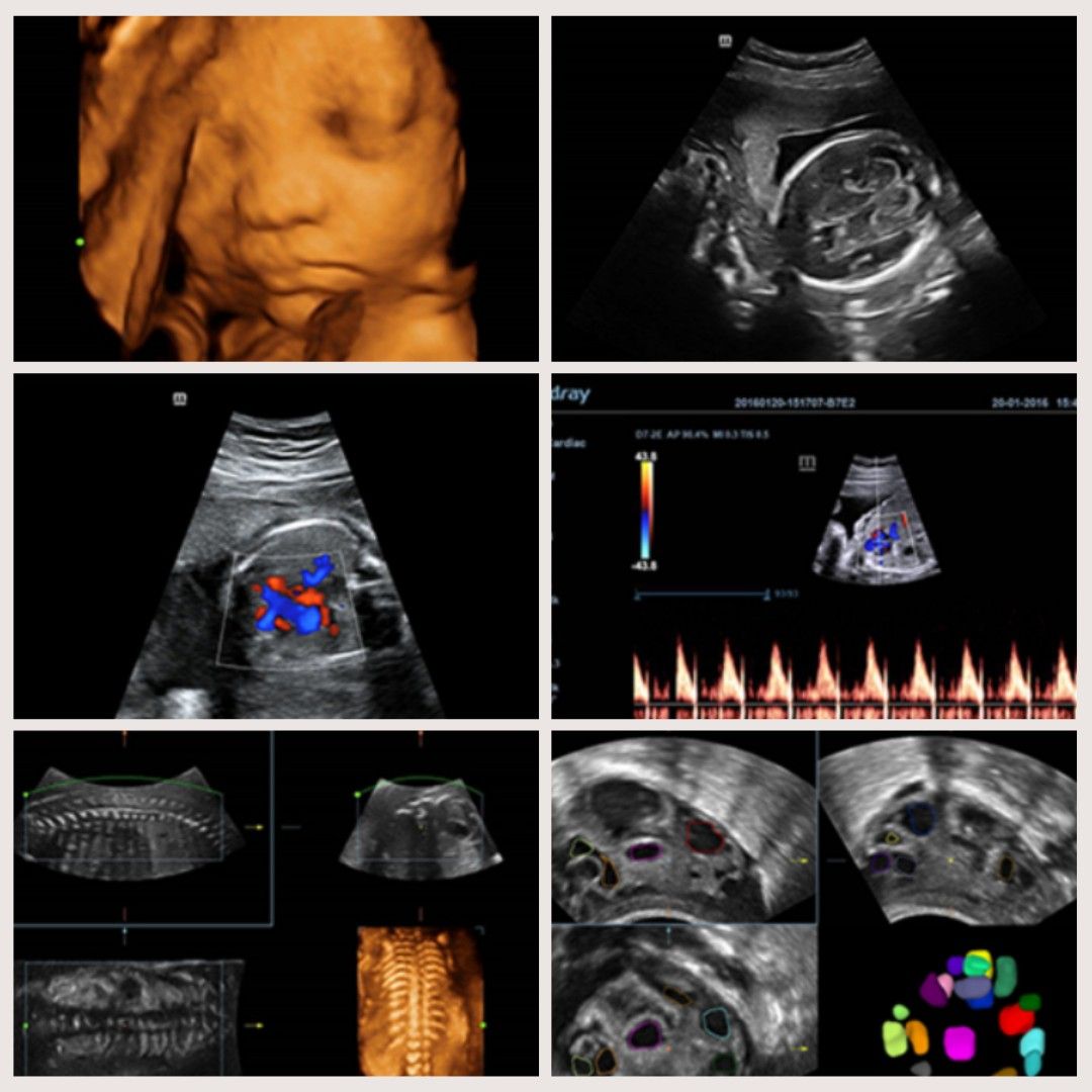 Mindray DC-40 Crystal: Pure Crystal Experience | Ultrasound System for Sale