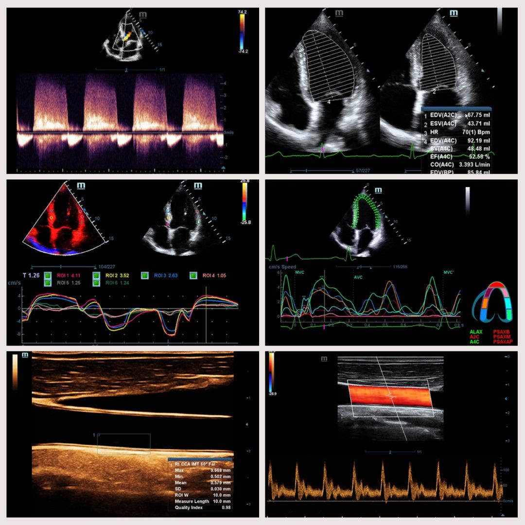 DC-60 ECHO with X-Insight: Advanced Ultrasound System for Sale in South ...