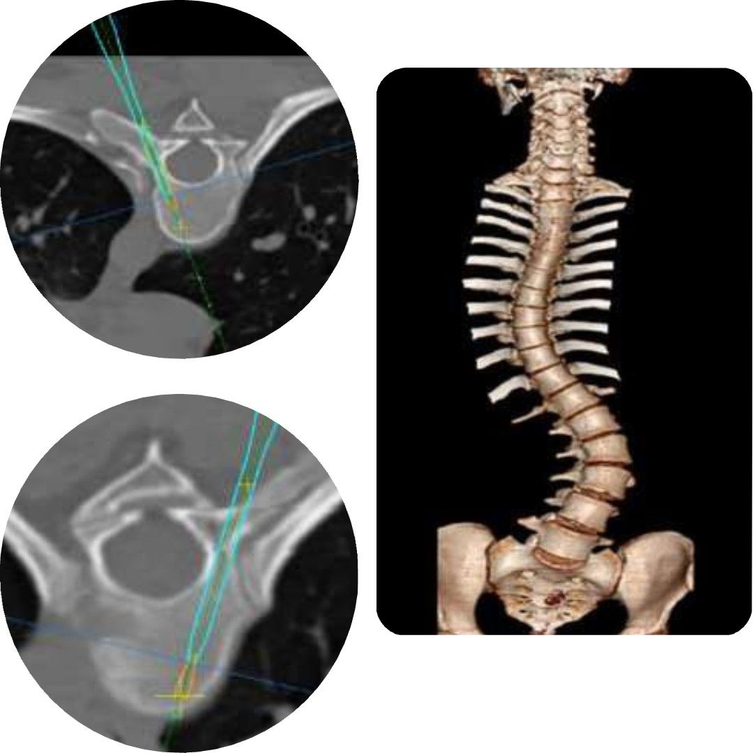 easyNav 2.0 Spine Navigation System - Top Spinal Surgery Navigation ...
