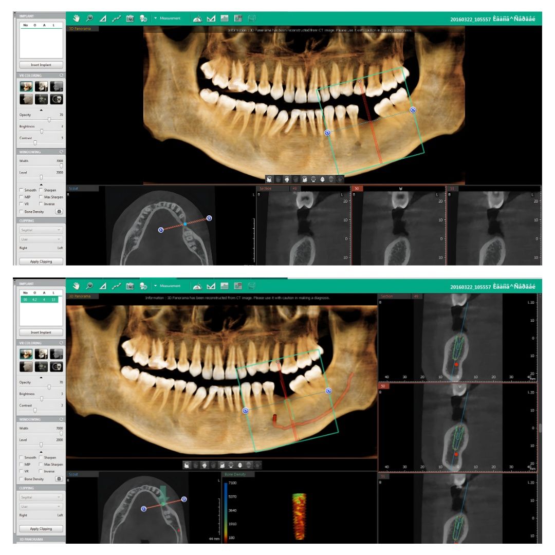 Advanced 3D Dental Software - Ez3D-i™ by Vatech