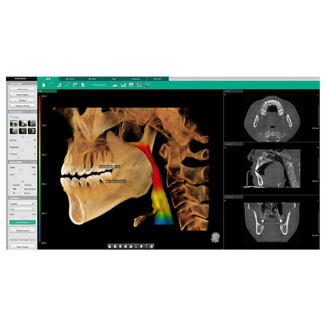 Advanced 3D Dental Software - Ez3D-i™ by Vatech