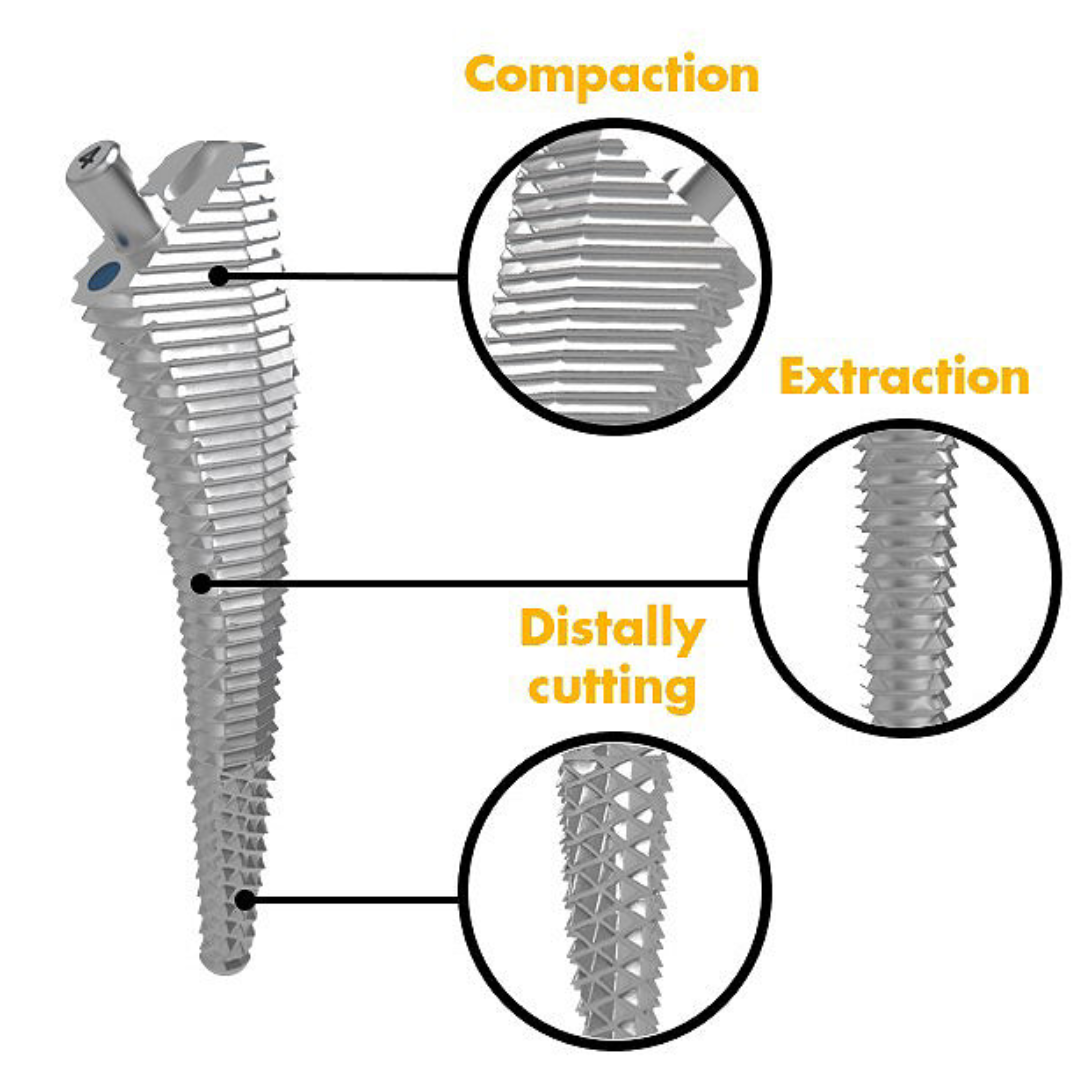 Insignia® Hip Stem - Hip Implant by Stryker