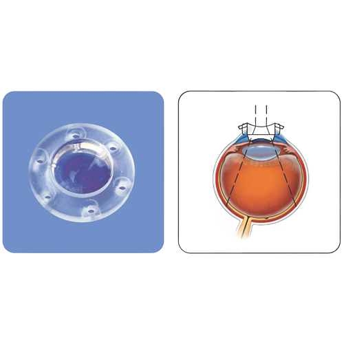 Opticlear Temporary Keratoprosthesis - Madhu Instruments Pvt. Ltd ...