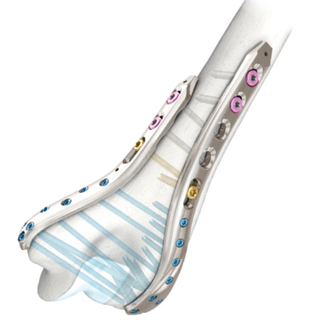 LOQTEQ® Elbow Plates 2.7/3.5 - Bone Plates by aap Implantate AG