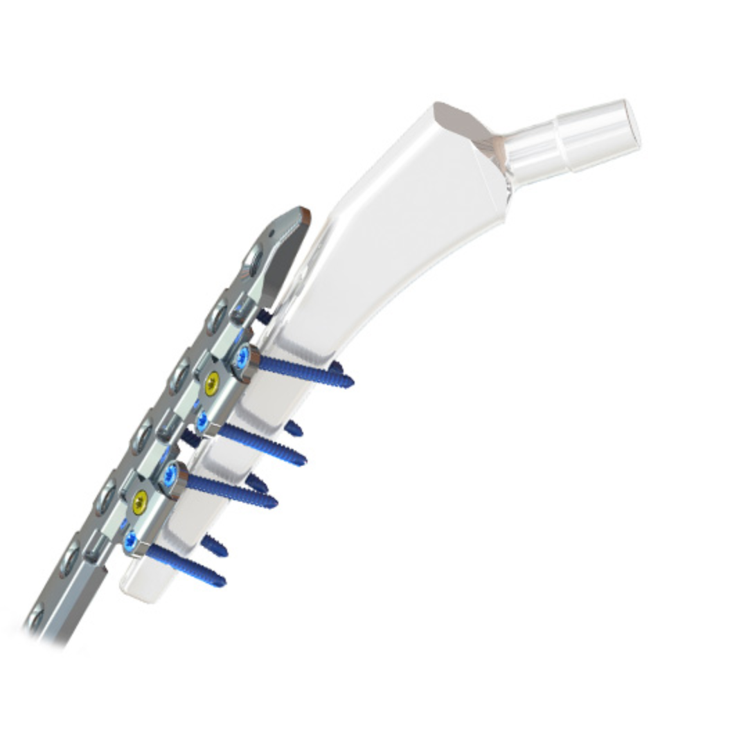 LOQTEQ® Periprosthetic Plating - aap Implantate AG