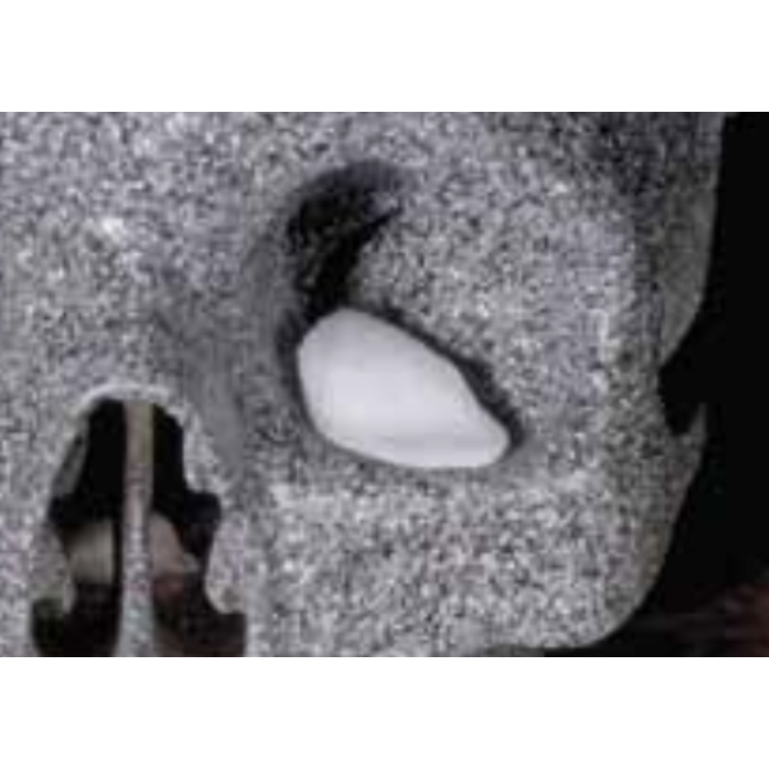 MEDPOR Enophthalmos Shapes Large Left by Akriti Ophthalmic