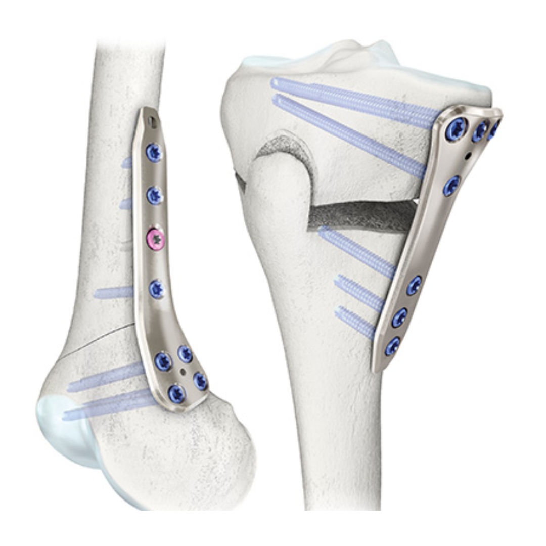 Osteotomy Plates 4.5 by aap Implantate AG - Suppliers