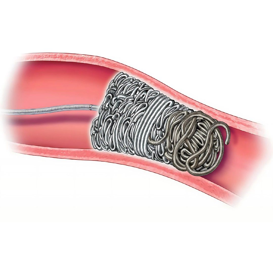 Packing Coil - detachable neuro embolization coil system | Penumbra, Inc.