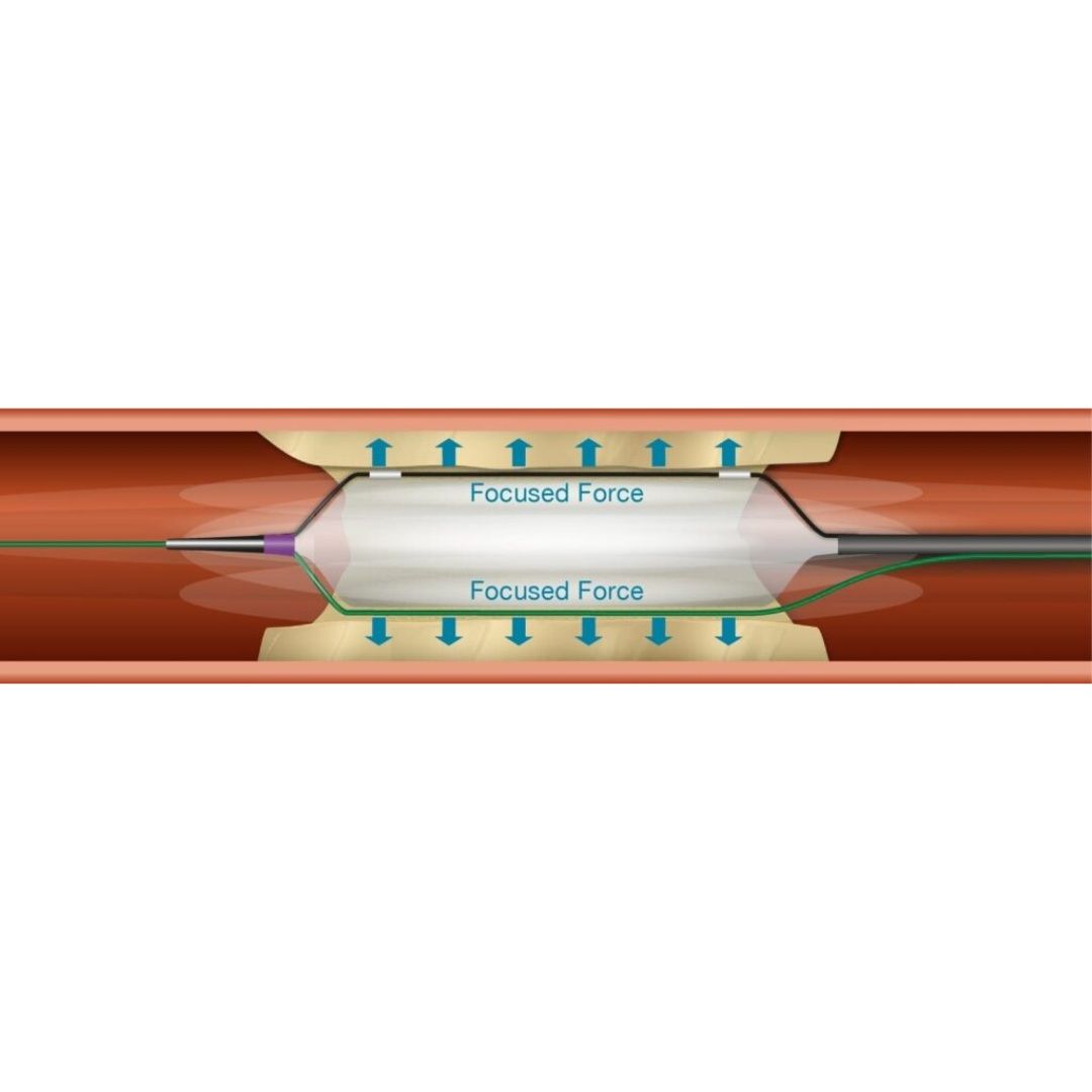 Scoreflex NC PTCA Balloon Catheters - Dilation Angioplasty ...