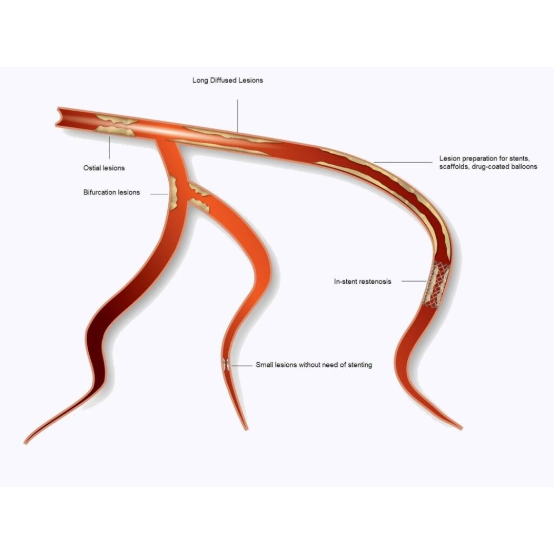 Scoreflex NC PTCA Balloon Catheters - Dilation Angioplasty ...