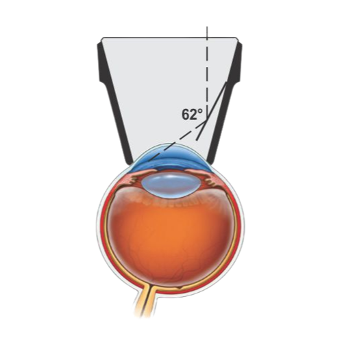 Opticlear Single Mirror Goniolens - Diagnostic & Surgical Lenses ...