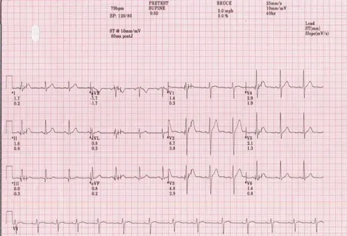 Stress TMT ECG Paper - Maddala Technologies India