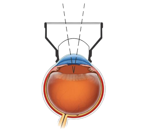 Opticlear YAG Capsulotomy Lens - Madhu Instruments Pvt. Ltd. | Medzell