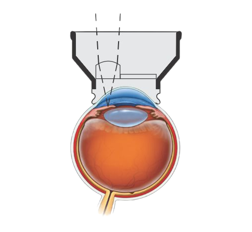 Opticlear YAG Iridectomy Lens - Madhu Instruments Pvt. Ltd. | Medzell